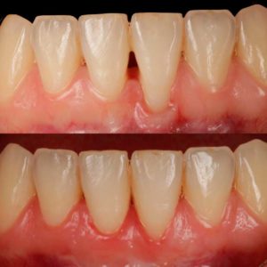 Injerto de encía ¿Qué es? Proceso, recuperación, consejos