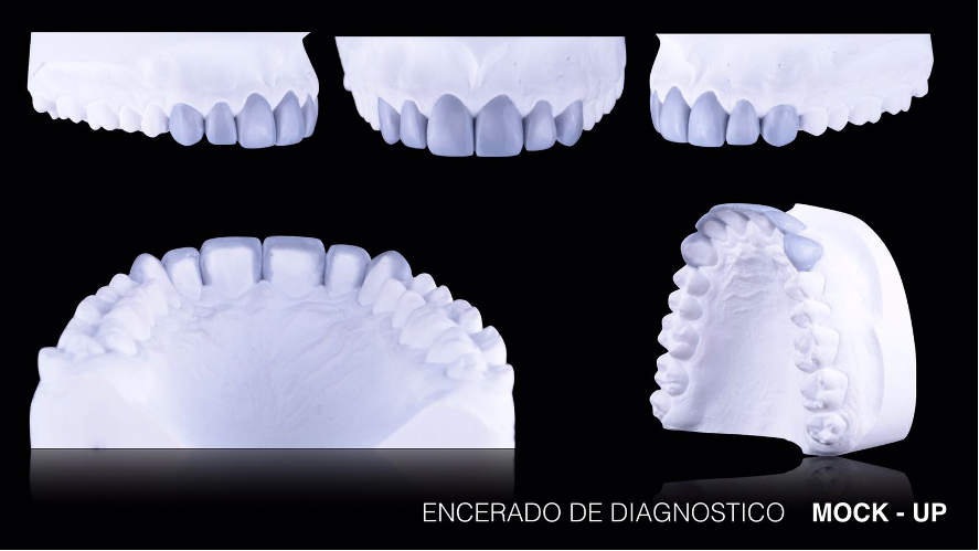 ¿Qué son las carillas de composite inyectado? - Dental Navarro