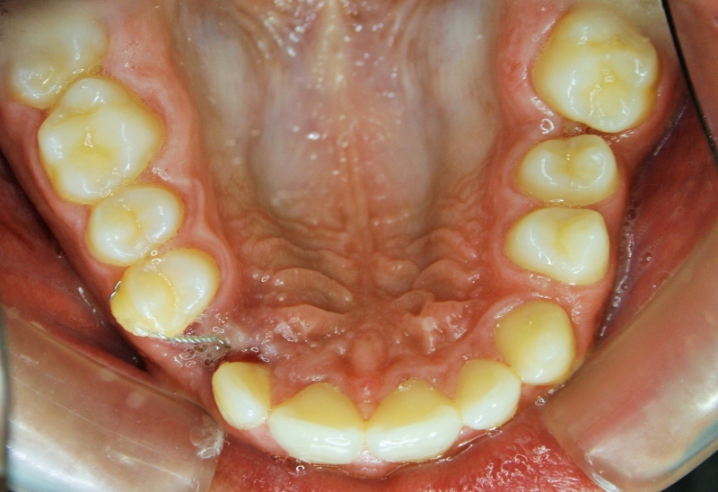 Extracción de dientes caninos incrustados en el hueso