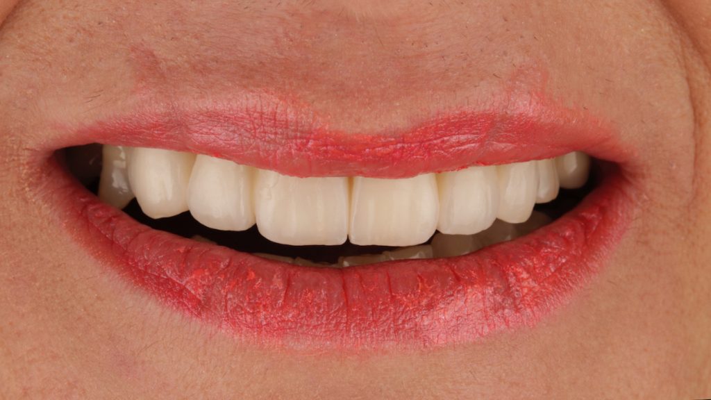 Rehabilitación anterior con prótesis fija e injertos mediante DSD