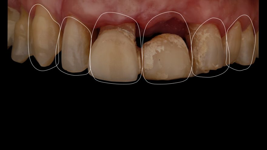 Rehabilitación anterior con prótesis fija e injertos mediante DSD
