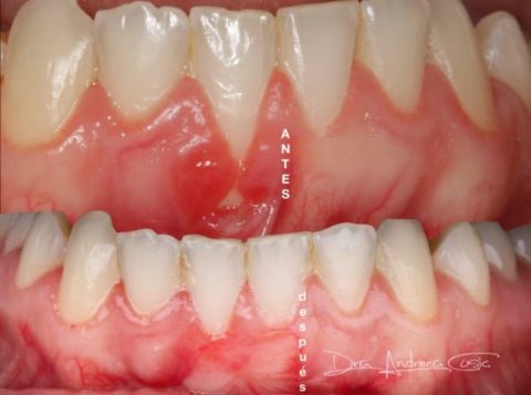 Caso de injerto de encía para solucionar recesión en incisivo inferior