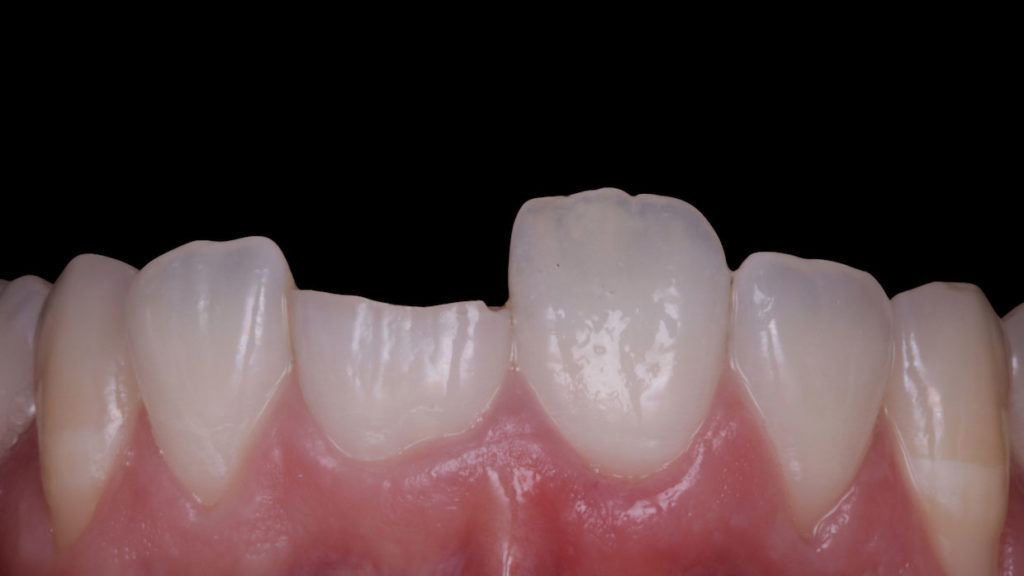 Caso de diente roto por traumatismo ¿Qué hacer? ¿Se puede pegar?