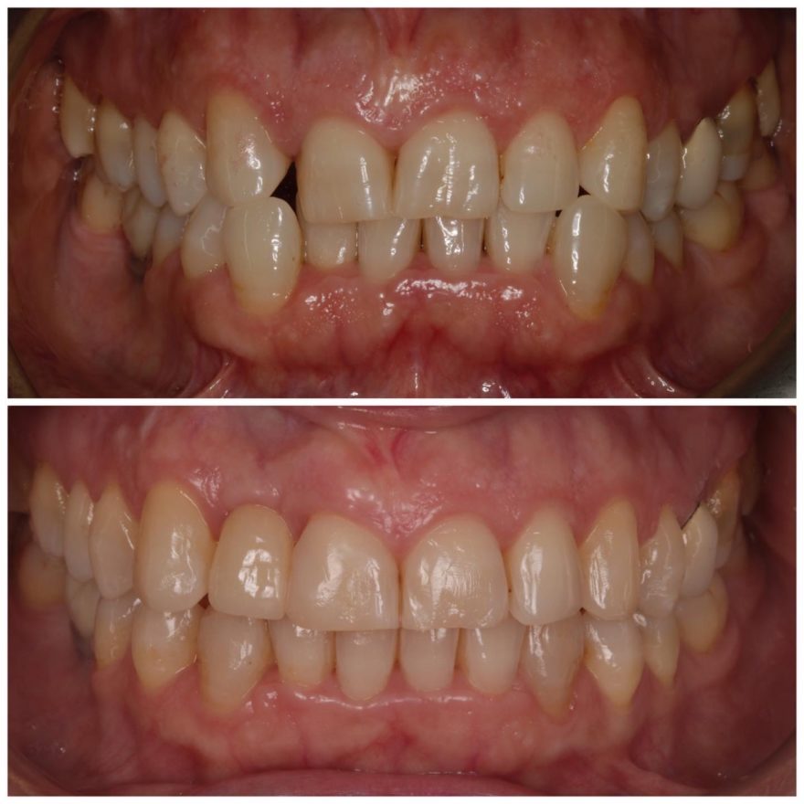 Solución agenesia dental - Caso clínico falta de diente - Ejemplo